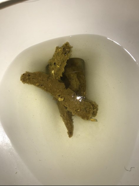 Colon Cancer Pictures Of Poop