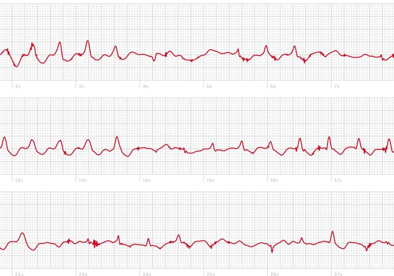 more strange heart rhythms! | British Heart Foundation