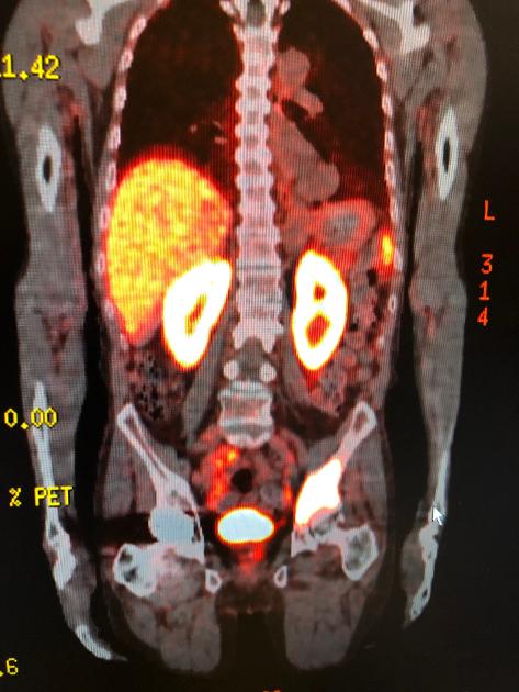 PSMA PET done: Got the results... - Advanced Prostate...