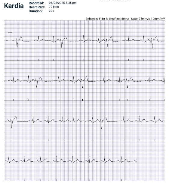 Trigeminy?: I have had one short... - Atrial Fibrillati...