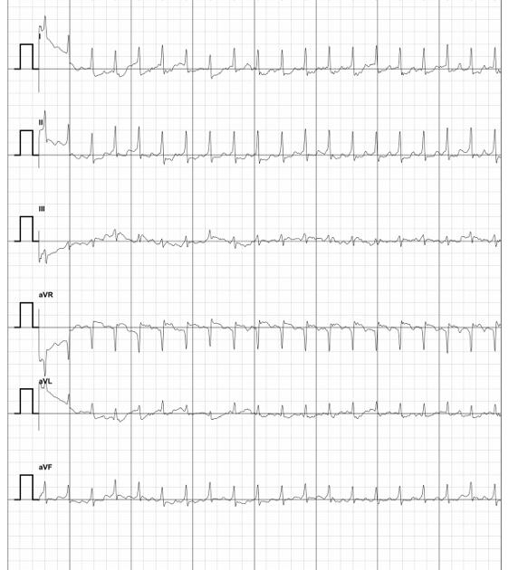SVT or Atrial Flutter? | Atrial Fibrillation Support
