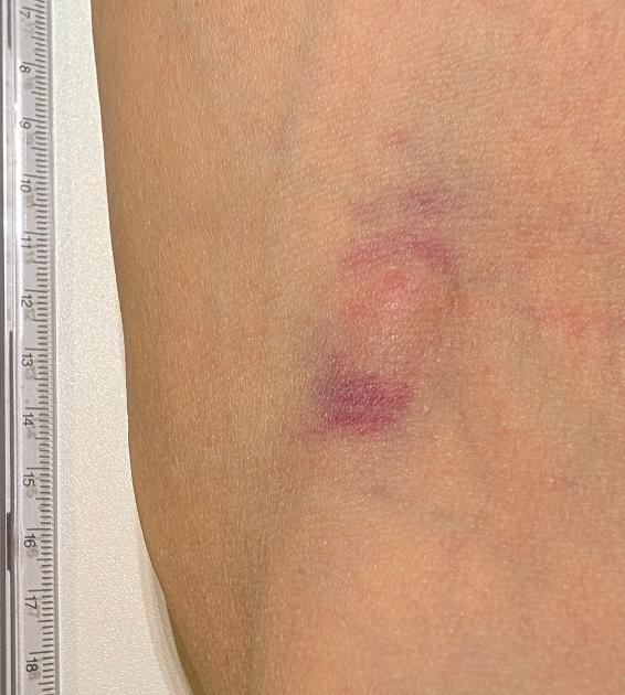 Swelling and Bruising After MRI Co... | Prostate Cancer N...