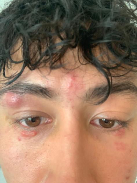 Persistent facial lesions on cheeks and ... | Changing Faces