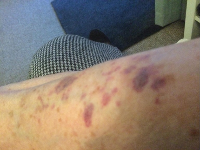 Purple marks on forearms | British Heart Foundation