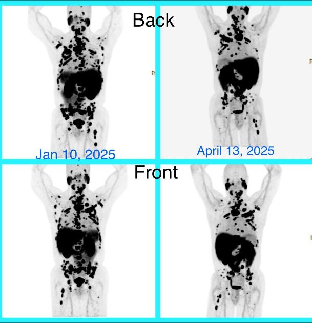 My Janx007 Trial 2025. : Introduction... - Advanced Prostate...