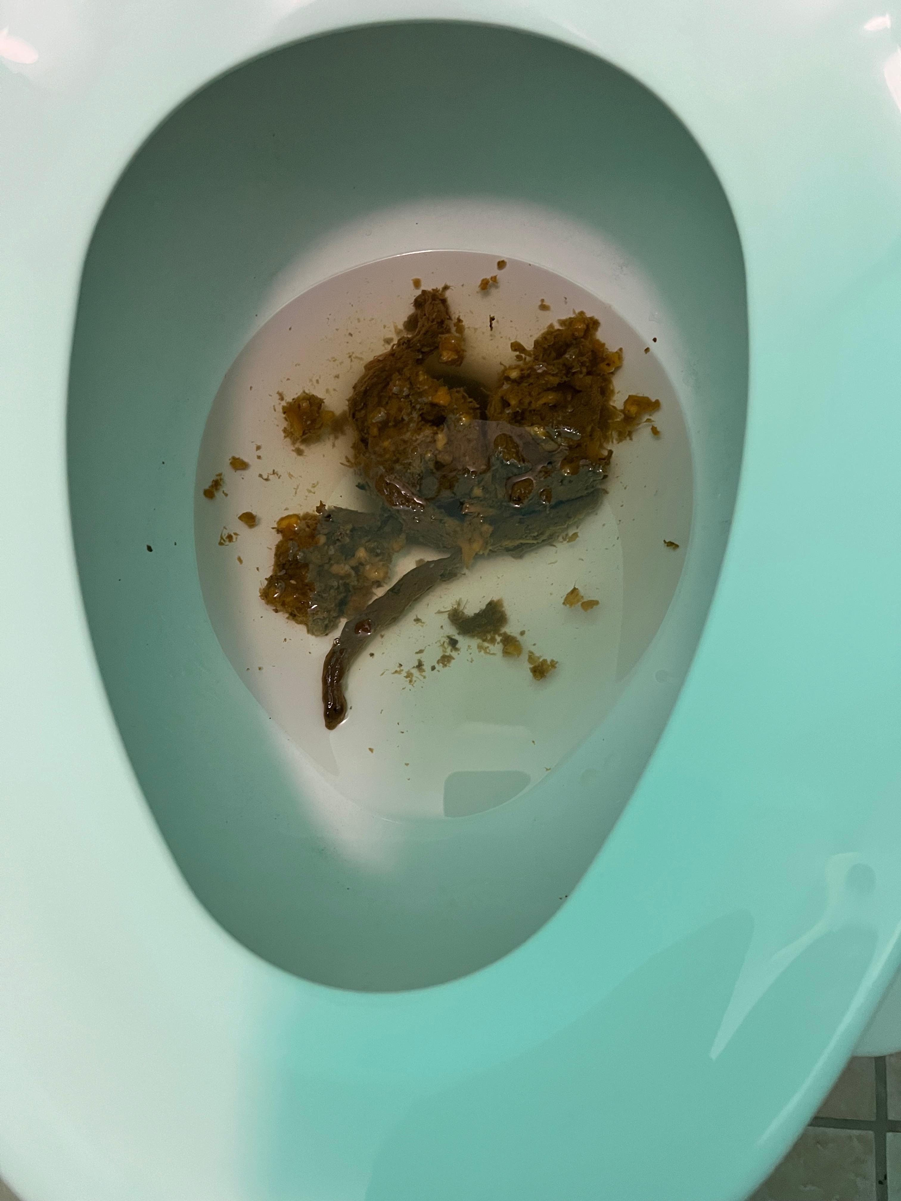 Colon Cancer Pictures Of Poop