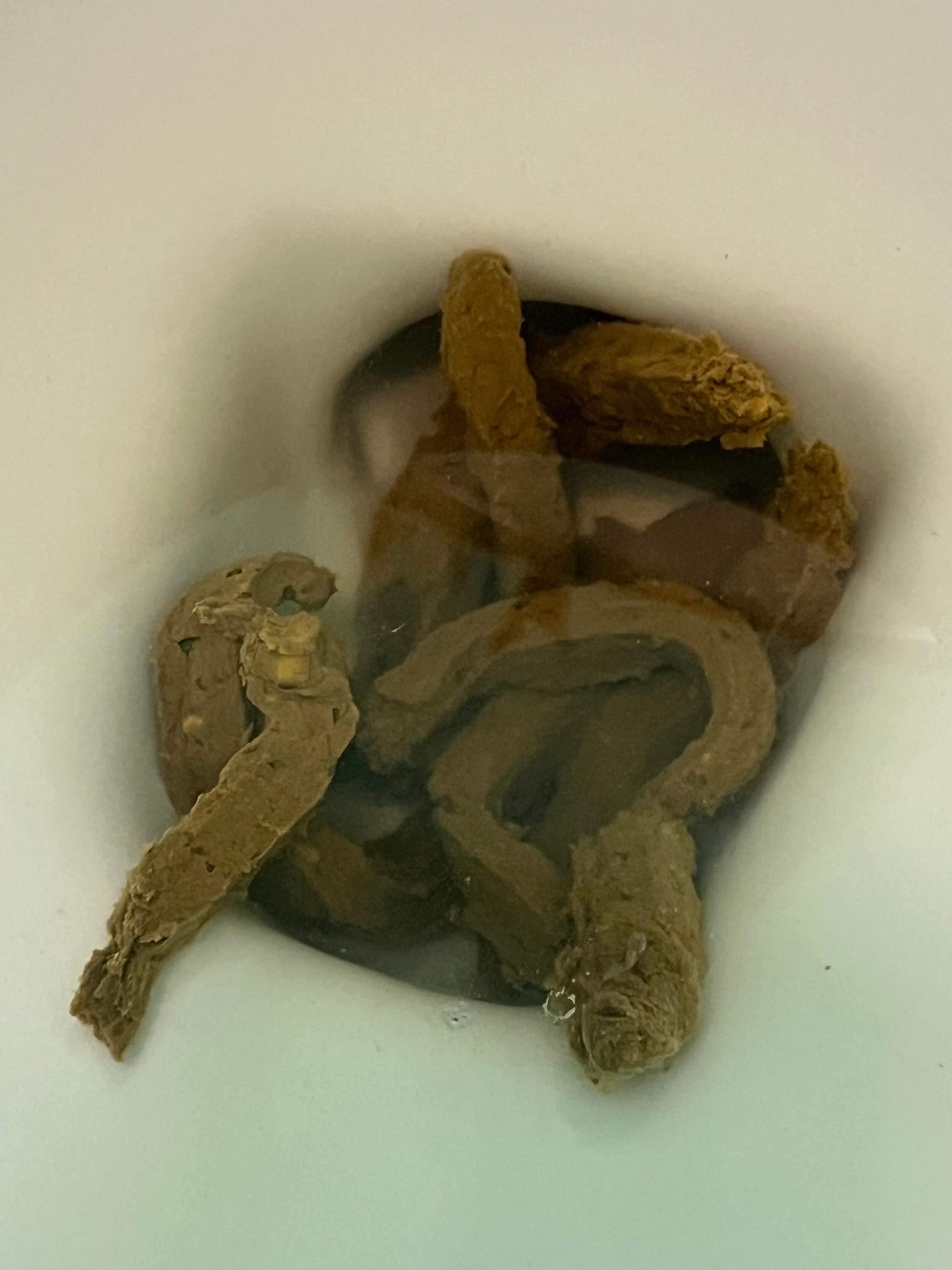 Colon Cancer Stool Shape