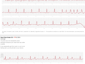 long periods of afibb: hi, since losing... - Atrial Fibrillati...