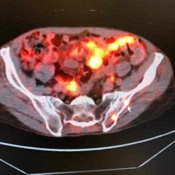 PSMA PET done: Got the results... - Advanced Prostate...