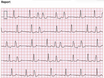 Ectopics | Atrial Fibrillation Support | HealthUnlocked