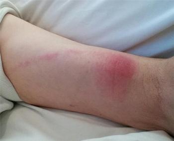 Post Injection Site Reactions and Cellulitis | CLL Support