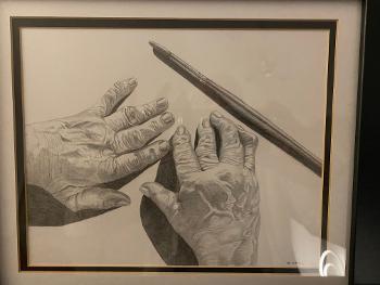 RD distorted fingers | NRAS | HealthUnlocked