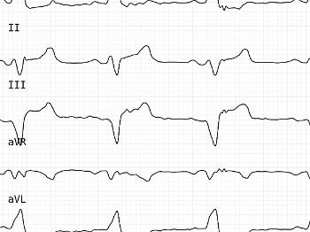 AF and Breathlessness | Atrial Fibrillation Support