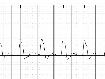 NSR but heart feels like afib - Atrial Fibrillati...