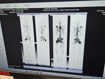 PSA , Bone pain ? | Advanced Prostate Cancer