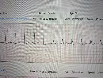 My small wellue holter picked up 'ven... - Atrial Fibrillati...