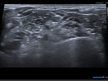 Ultrasound Images Hashimototos or Not | Thyroid UK