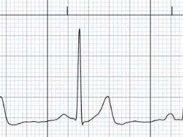 NSR but heart feels like afib - Atrial Fibrillati...
