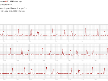 PACs upon mild exertion: Hi all. 64 yr... - Atrial Fibrillati...